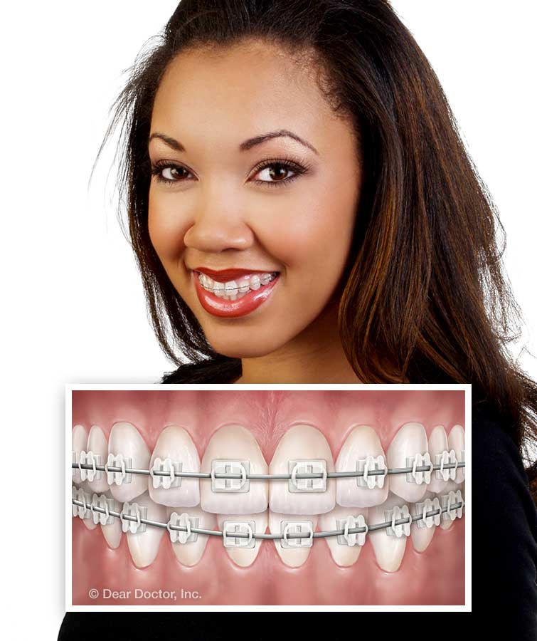 Types Of Braces Kokodynski Orthodontics Lake Geneva Wisconsin
